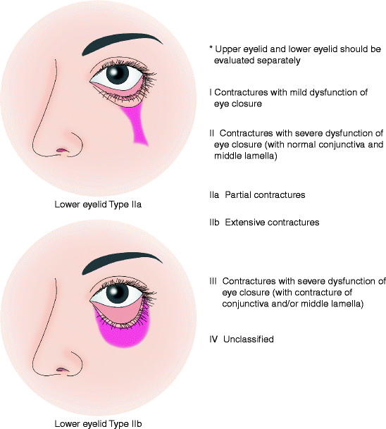 Diagnosis, Assessment, and Classification of Scar Contractures ...
