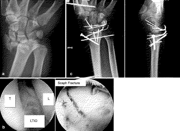 Lunotriquetral and Extrinsic Ligaments Lesions Associated with Distal ...