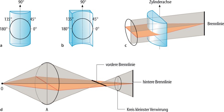Refraktionsfehler: Brillen, Kontaktlinsen und refraktive Chirurgie ...