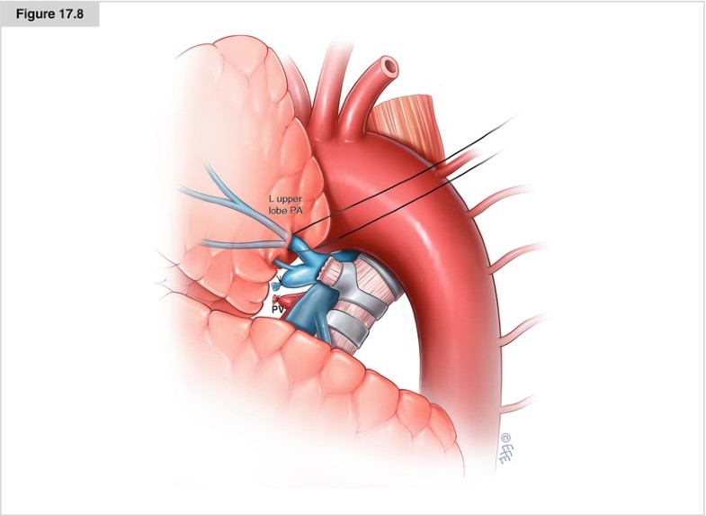 Pulmonary Lobectomy (Thoracotomy and VATS) | SpringerLink