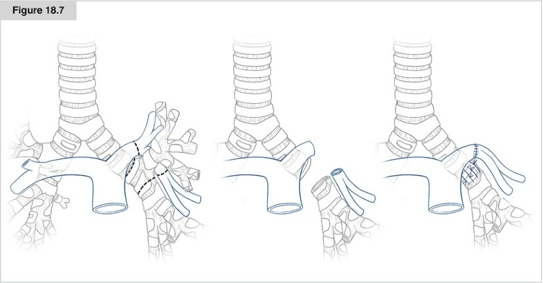 Bronchial Sleeve Resection | SpringerLink