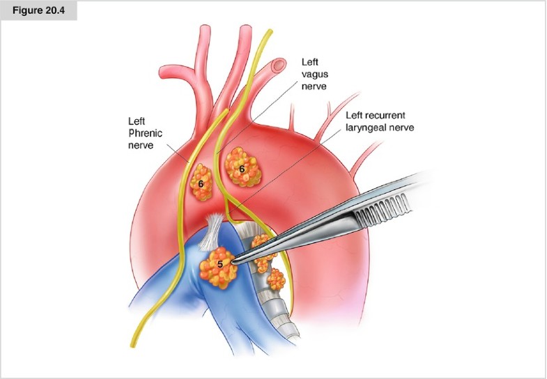 Lymph Node Dissection | SpringerLink