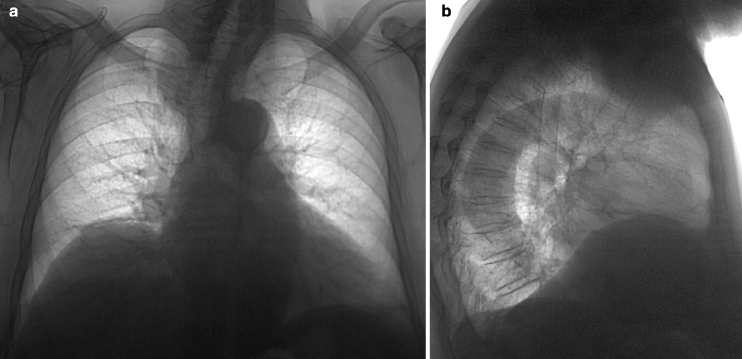 Substernal Goiter | SpringerLink