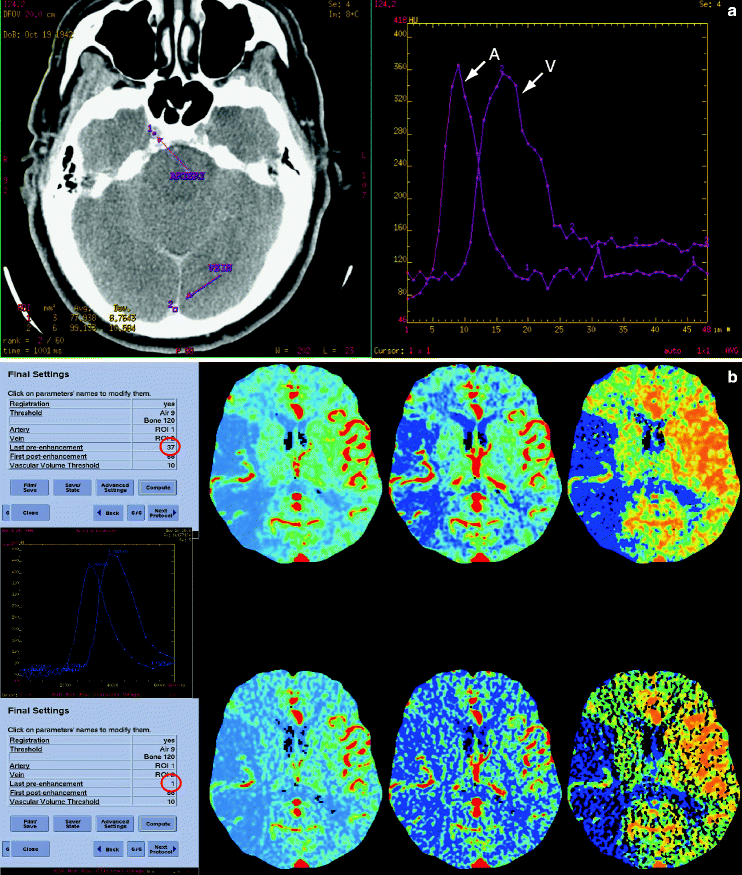 CT Perfusion (CTP) | SpringerLink