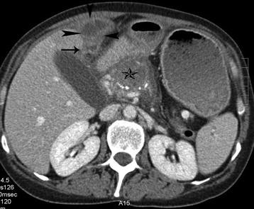 Mesentery, Omentum, Peritoneum: Embryology, Normal Anatomy and Anatomic ...