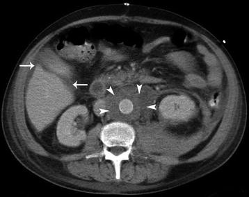 Mesentery, Omentum, Peritoneum: Embryology, Normal Anatomy and Anatomic ...