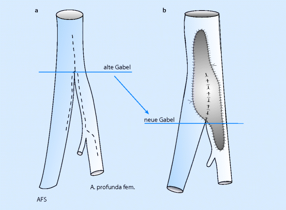 Femoralisgabel prozesse | SpringerLink