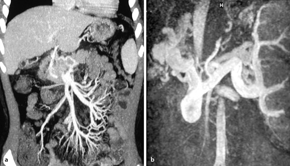 Thrombosen des Pfortader systems | SpringerLink