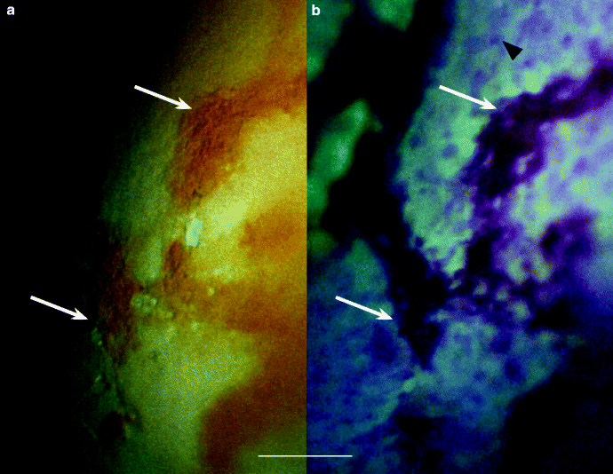 The Morphology of Varicella-Zoster Virus Epithelial Keratitis in Herpes ...