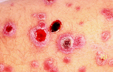 Early and Late Syphilis | SpringerLink