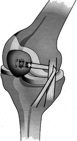 MPFL Reconstruction | SpringerLink