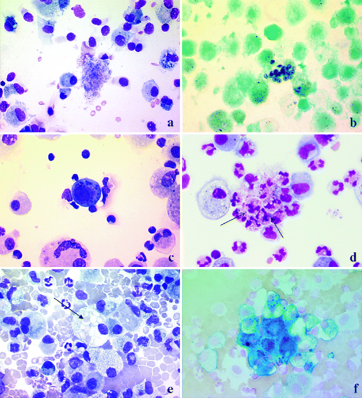 Diagnostic Yield of BAL Fluid Cytology in Hematologic Malignancies ...