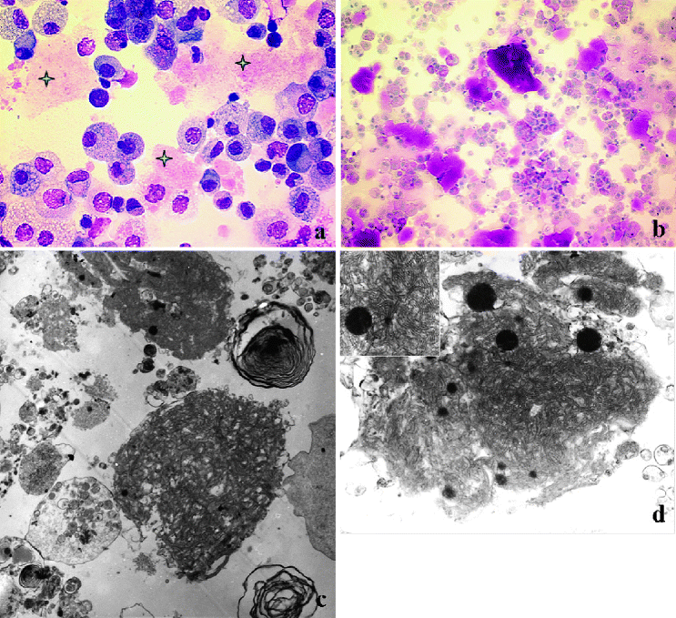 Diagnostic Yield of BAL Fluid Cytology in Hematologic Malignancies ...