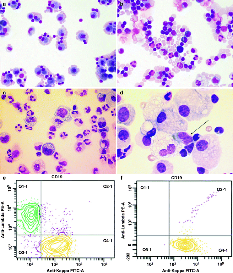 Diagnostic Yield of BAL Fluid Cytology in Hematologic Malignancies ...