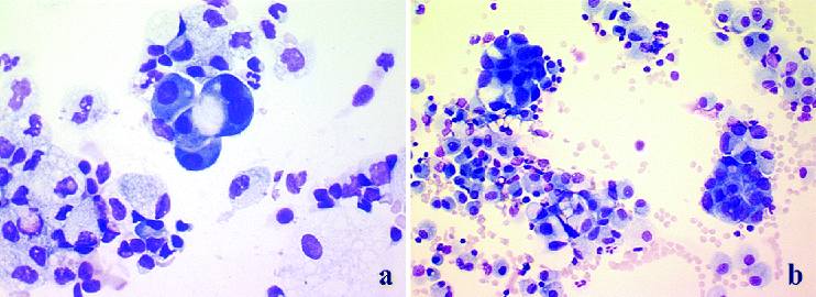 Diagnostic Yield of BAL Fluid Cytology in Hematologic Malignancies ...