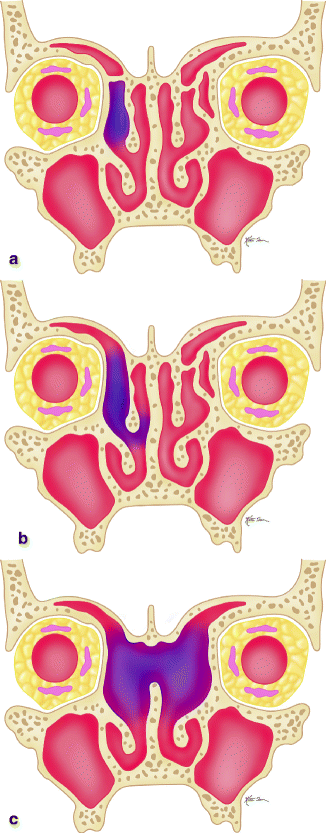 Imaging the Paranasal Sinuses and Nasal Cavity After Surgery | SpringerLink
