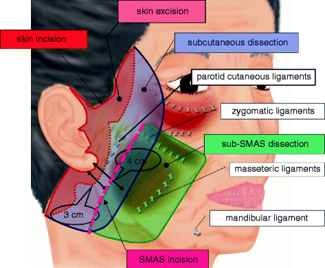 Suspension of the Retaining Ligaments and Platysma in Facelift: From ...