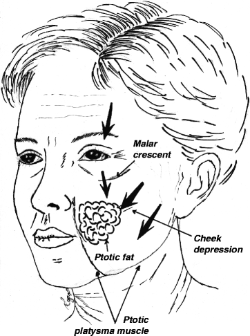Anatomicohistologic Study of the Retaining Ligaments of the Face with ...