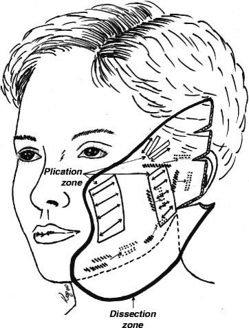 Anatomicohistologic Study of the Retaining Ligaments of the Face with ...