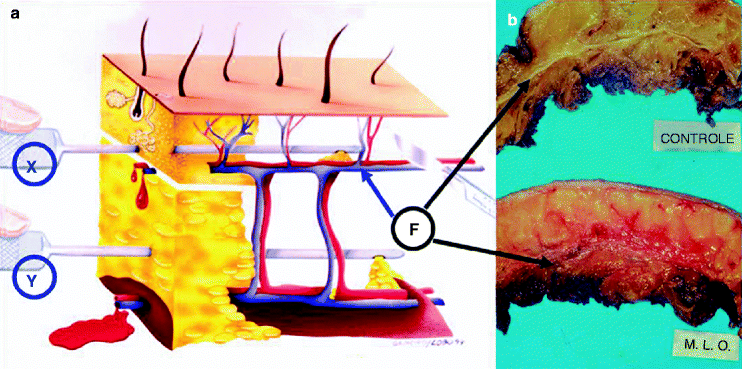 Principles of Liposuction | SpringerLink