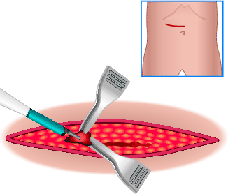 A8 Transverse Supraumbilical Incision | SpringerLink