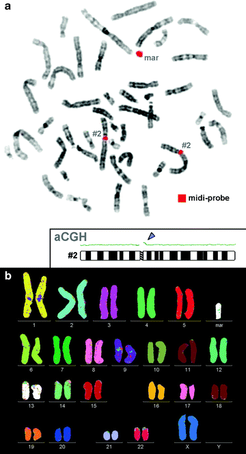 Small Supernumerary Marker Chromosomes in Genetic Diagnostics and Counseling | SpringerLink