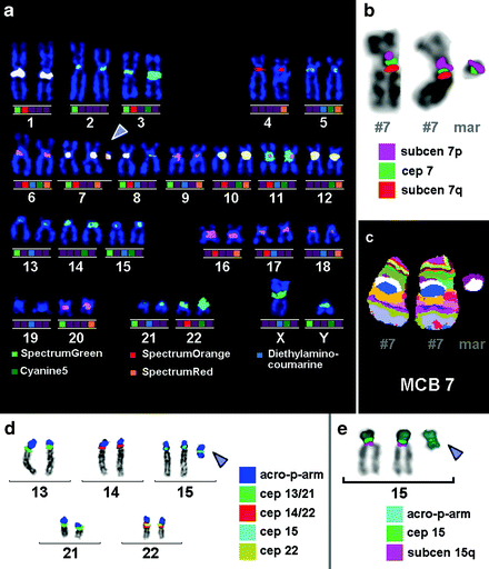 Small Supernumerary Marker Chromosomes in Genetic Diagnostics and ...