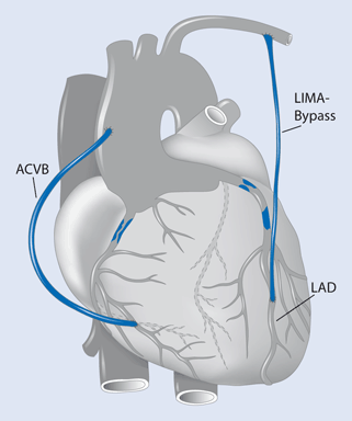 Aortokoronare Bypassoperation | SpringerLink