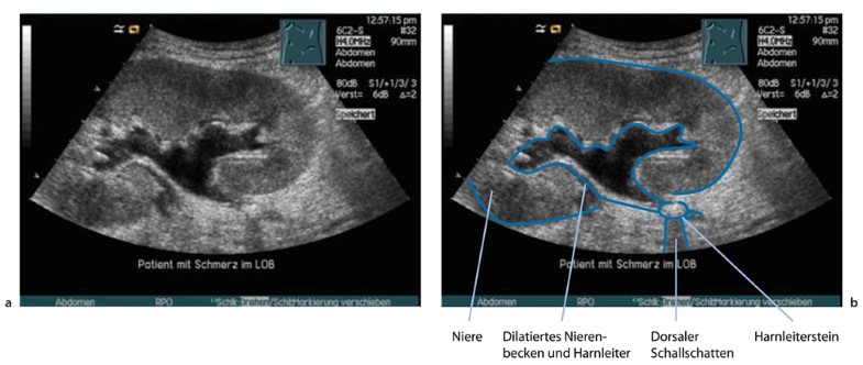 Gutartige Veränderungen von Harnleiter und Blase | SpringerLink
