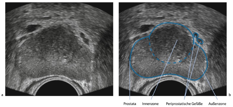 Normalbefunde von Prostata und Samenblasen | SpringerLink