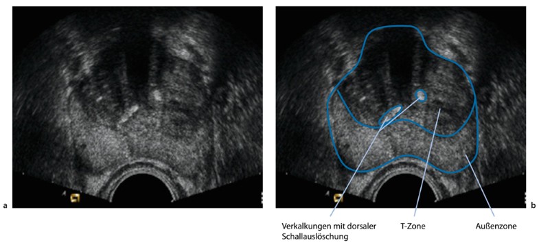 Gutartige Veränderungen von Prostata und Samenblasen | SpringerLink