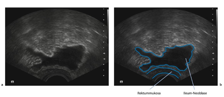 Postoperative Befunde von Prostata und Samenblasen | SpringerLink