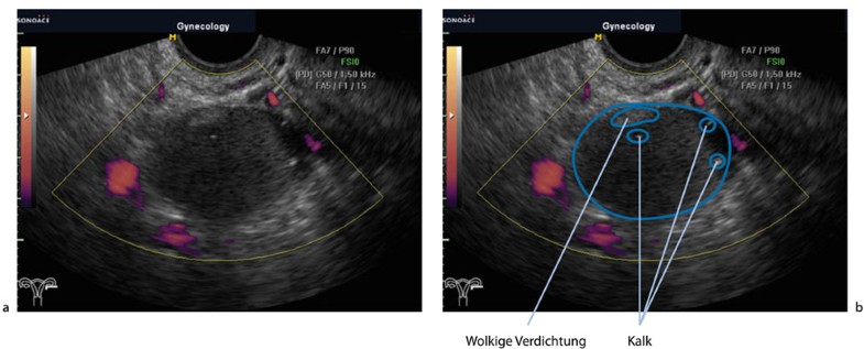 Gynäkologischer Ultraschall | SpringerLink