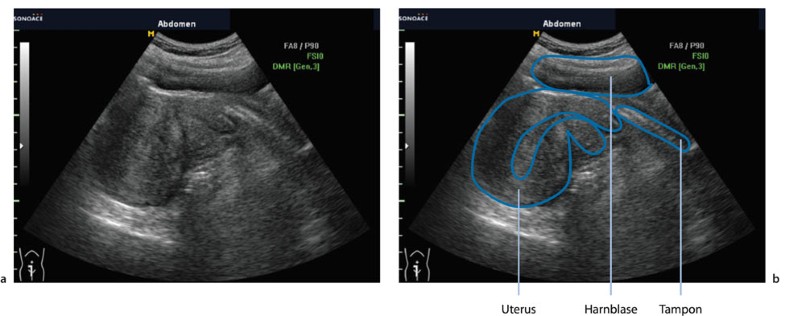 Gynäkologischer Ultraschall | SpringerLink