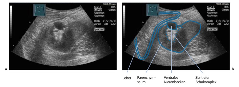 Normalbefunde und Normvarianten der Niere | SpringerLink