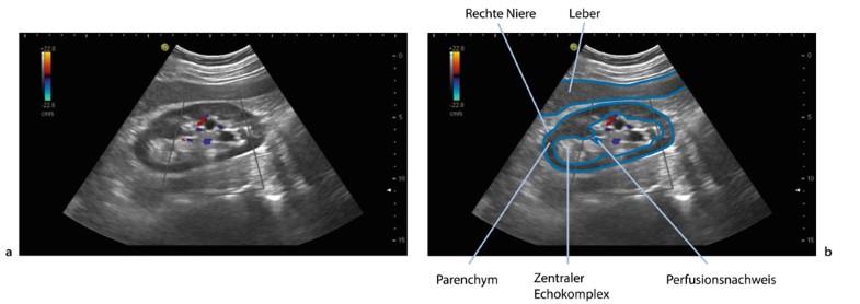 Normalbefunde und Normvarianten der Niere | SpringerLink