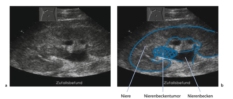 Bösartige Veränderungen der Niere | SpringerLink