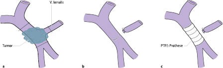 Pfortadersystem | SpringerLink