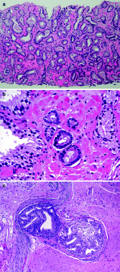 Contemporary Approach to Gleason Grading of Prostate Cancer | SpringerLink