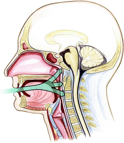 Transoral Resection of the Odontoid Process | SpringerLink