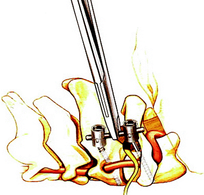 C1–C2 (Harms) Technique | SpringerLink