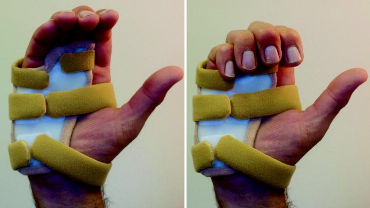 Hand Therapy for Dupuytren’s Contracture | SpringerLink