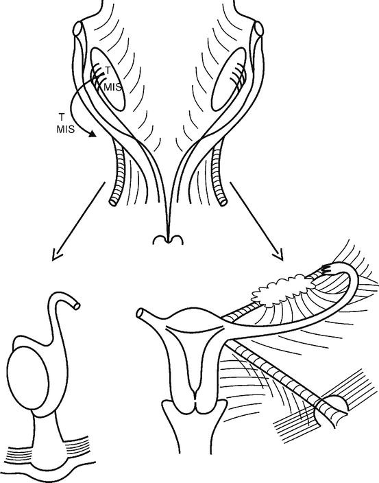 The Neonate with Ambiguous Genitalia | SpringerLink