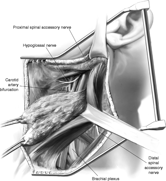 Modified Radical Neck Dissection | SpringerLink