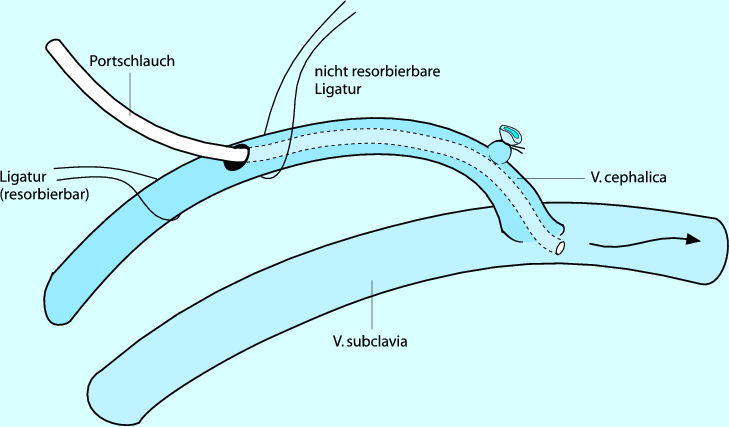 Portimplantation | SpringerLink