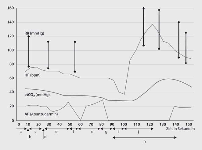 Anästhesiologische Aspekte der EKT | SpringerLink