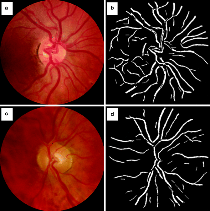 Retinal Vascular Imaging for Cardiovascular Risk Prediction | SpringerLink