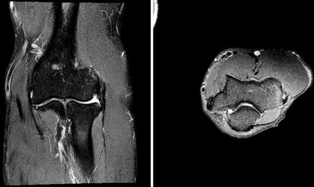 Tennisellbogen mit Partialruptur der Extensorenansätze am Epicondylus ...