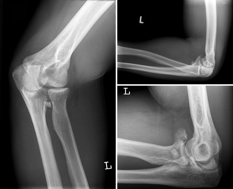 Ellbogenluxationsfraktur mit mehrfragmentärer Fraktur des Processus ...