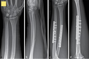 Unterarmschaft | SpringerLink